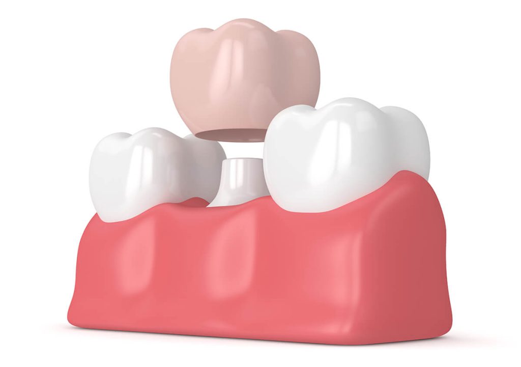 Tooth Colored Porcelain Crowns Chino Hills CA - Restore Teeth